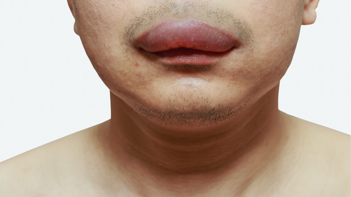 Swollen Upper Lip Causes Symptoms Sudden And Top Lip Swelling swollen-upper-lip-causes-symptoms-sudden-and-top-lip-swelling